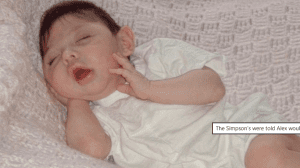 Alex Simpson's Brain: The Girl Who Lived Without a Cerebrum